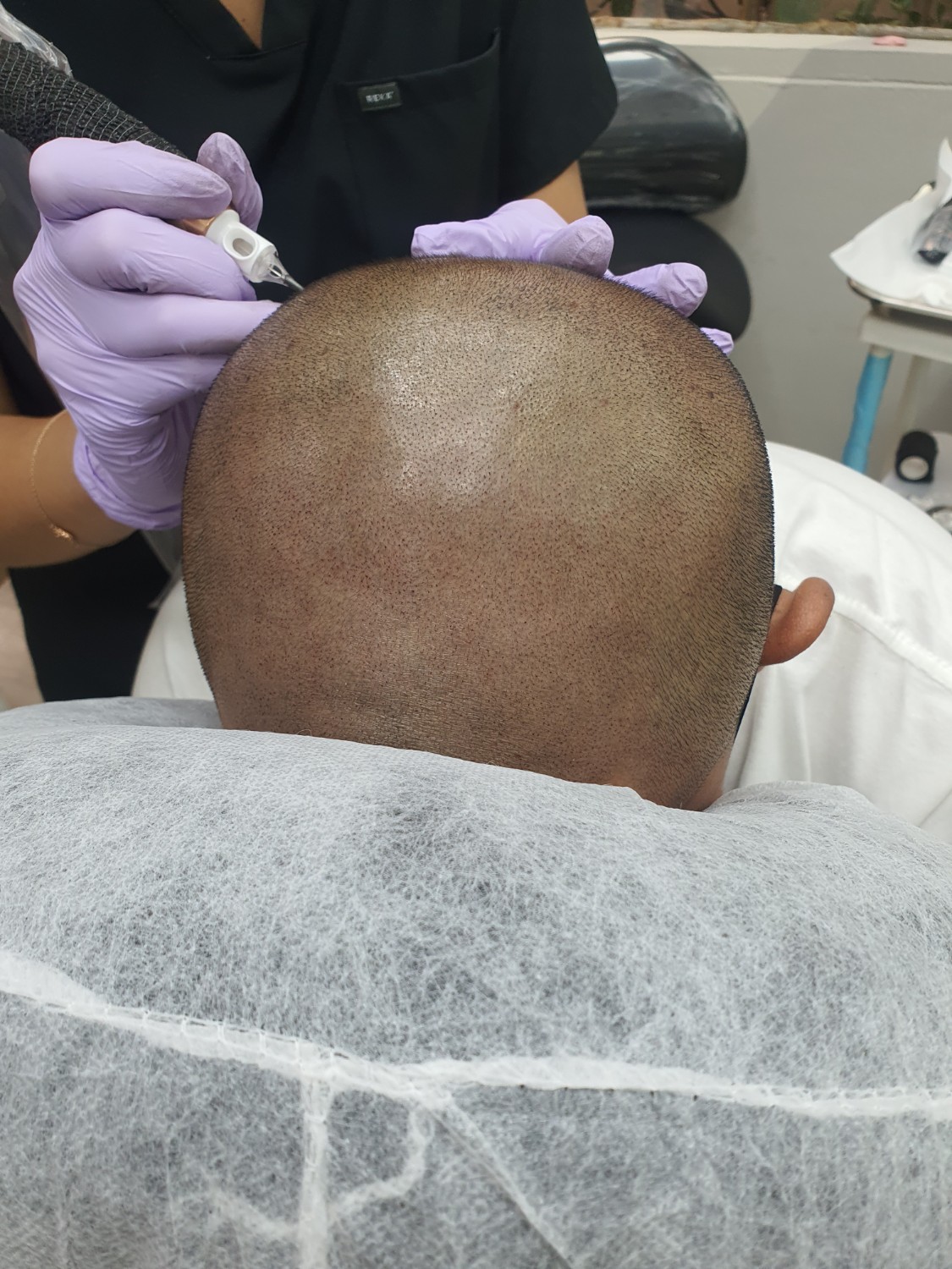 SMP Patong Hair tattoo Phuket Scalp micropigmentation Skinhead tattoo ...